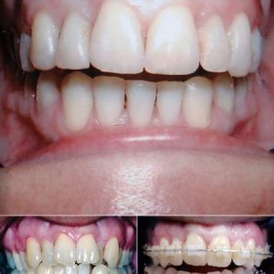 Superb Results - Simcoe Smile Dental